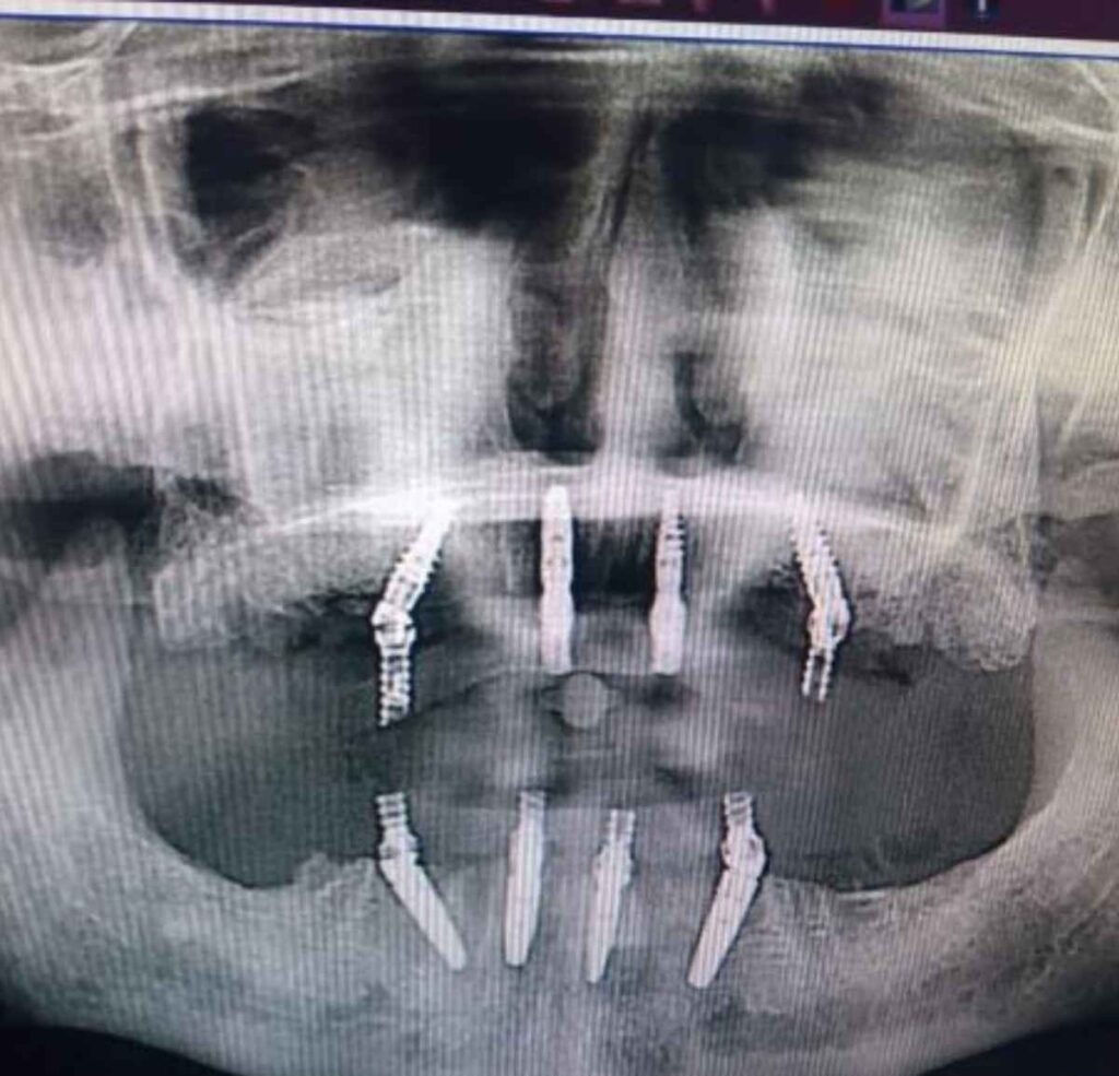 Dental Implants for a Lasting Smile | Dr. Shwetha's Clinic