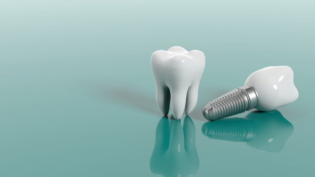 Dental Implants for a Lasting Smile | Dr. Shwetha's Clinic