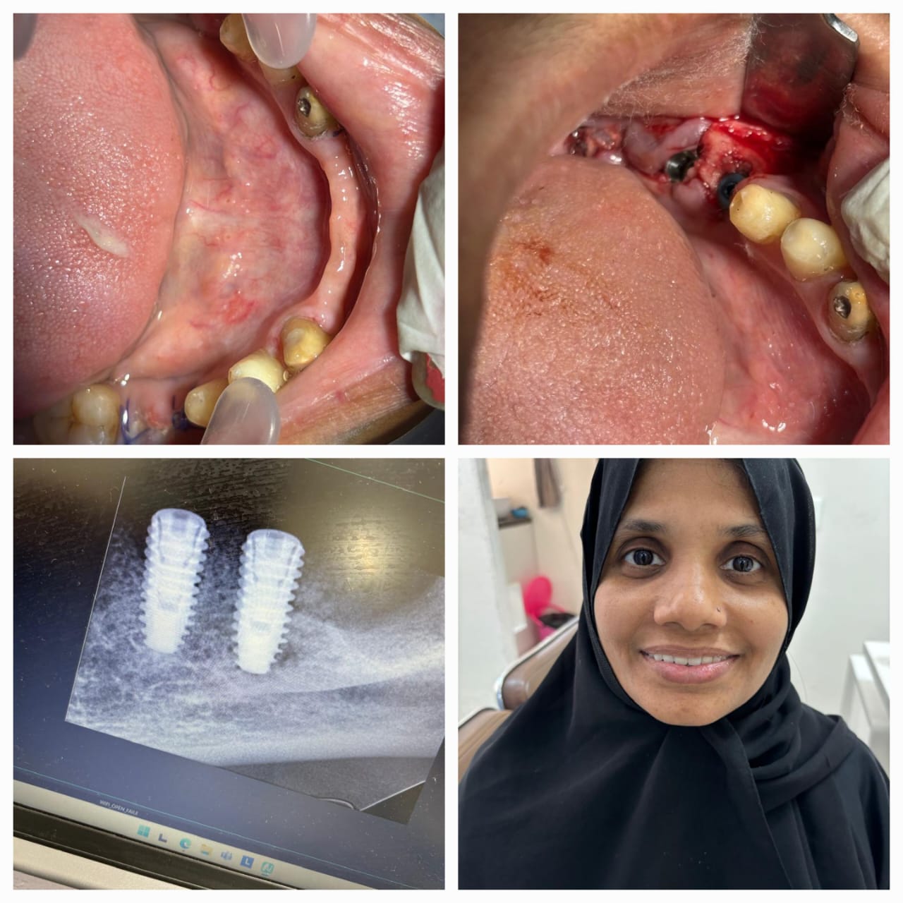 Dental Implants: Your Permanent Solution for Missing Teeth