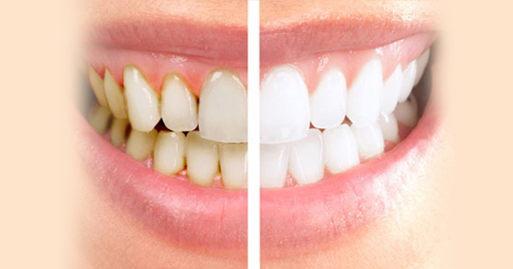Teeth Cleaning and Polishing – Everything You Need to Know - Dr Shwetha